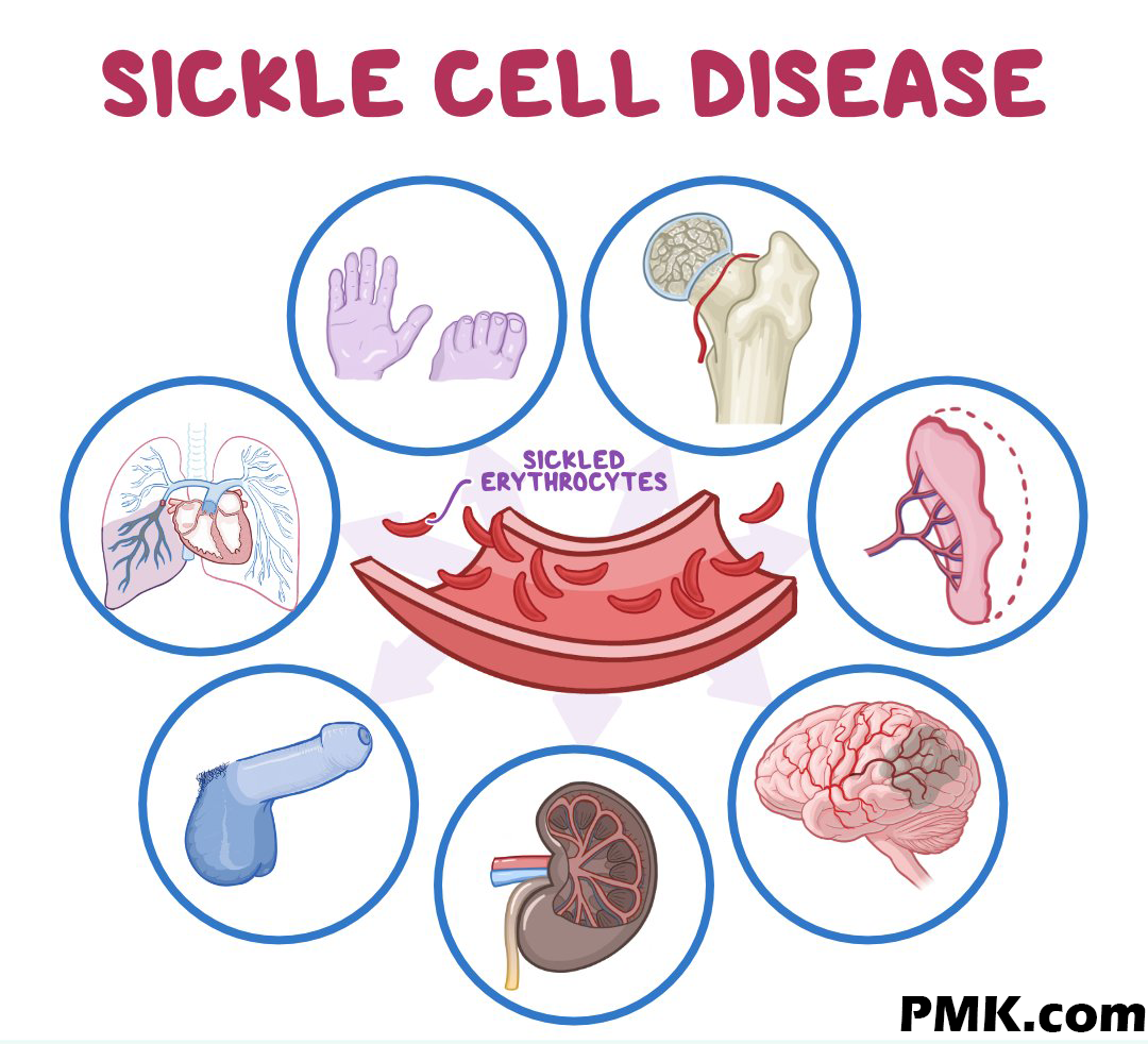 Sickle Cell Anemia Signs And Symptoms Crisis Diagnosis And Treatment Professional Med